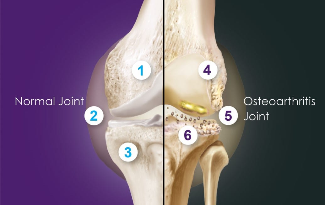 What is OA - Bioventus OA Knee Pain Relief